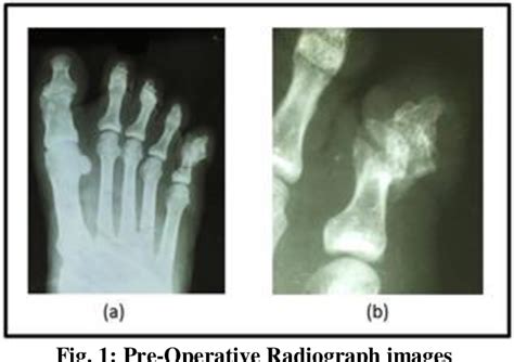 Figure 1 From Osteoid Osteoma Of Phalanx Of Small Toe Semantic Scholar