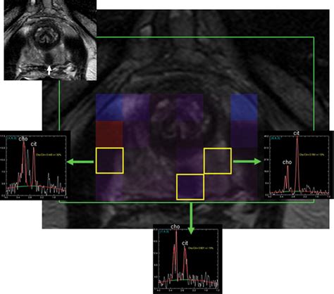 Prostate Mri And 3d Mr Spectroscopy How We Do It Ajr
