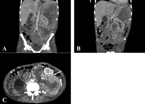 Cts Showing Retroperitoneal Mass A Coronal Image From Download