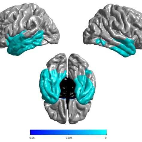 Brain Regions With Significantly Reduced Cortical Thickness In Sd
