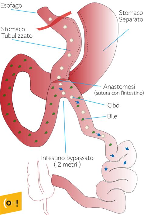 Mini Bypass Gastrico Obesityhelp