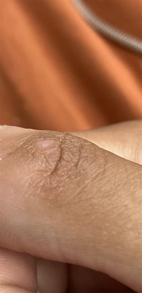 Is This The Start Of A Wart Growing Or A Scar Rwarts