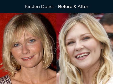 Kirsten Dunst Teeth Before After Kirsten Dunst Forced To Fix Teeth