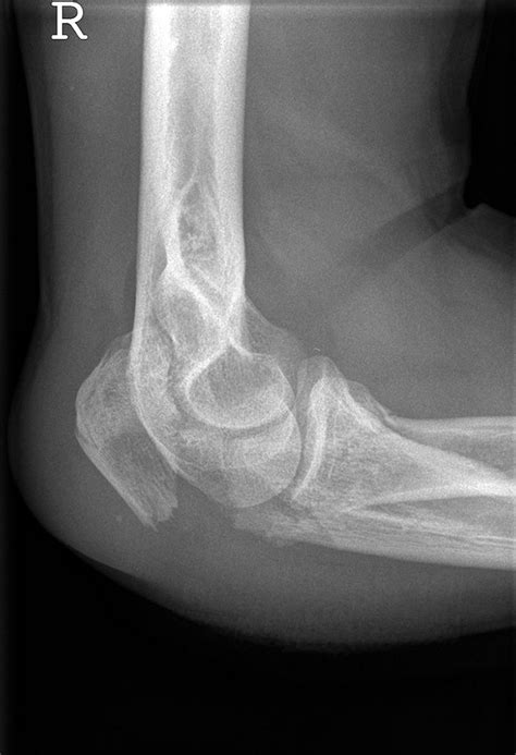 Fracture Du Coude Traumatisme à Traiter En Chirurgie Mon Épaule