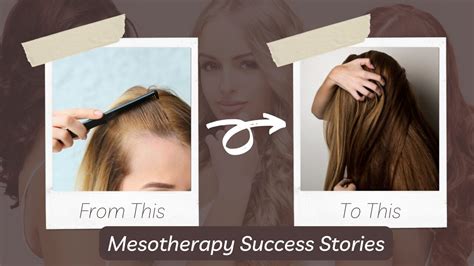 Mesotherapy For Hair Loss Real Results And Success Stories