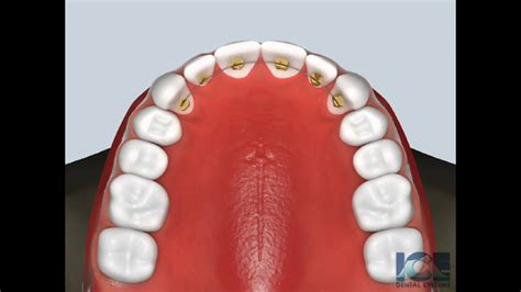 Retainer For Top Teeth