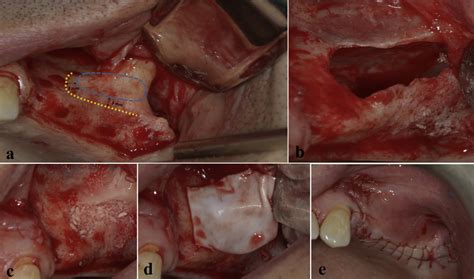 Surgical Steps Of The Lateral Window Technique A Lateral Window