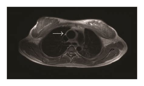 Mri Mra Through The Chest Abdomen And Pelvis Was Obtained A Axial Download Scientific