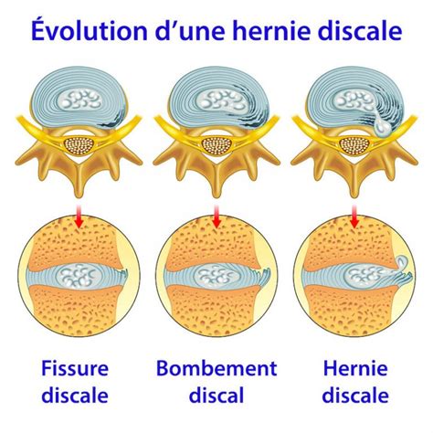 Nerf Sciatique Quoi Faire Pour Soulager La Douleur Et éviter Les Récidives
