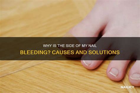 Why Is The Side Of My Nail Bleeding Causes And Solutions Nailicy