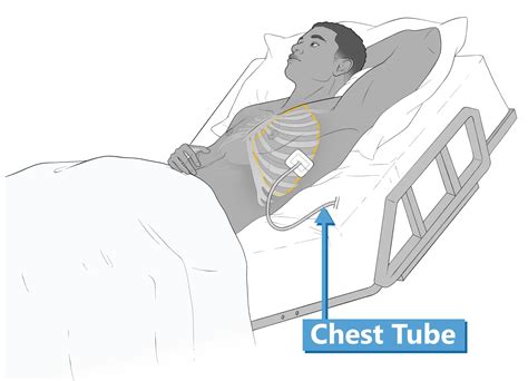 Chest Tube For Pneumothorax