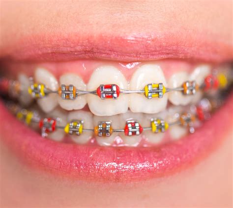 Fixed Metal Braces Skip Nhs Lines Yorkshire Orthodontics