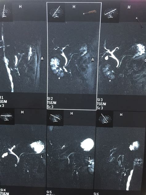 Concomiant Laparoscopic Splenectomy And Laparoscopic Cholecystectomy