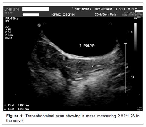 Hysteroscopic Resection Of A Giant Cervical Polyp With Preservation Of