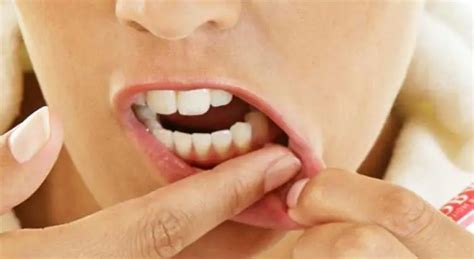 Odontogenic Periostitis Flux Stages Causes And Features Of