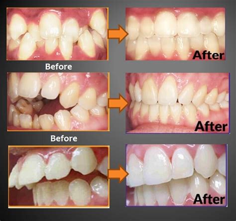 Fast Braces Chester And North Wales None Extraction Braces Quick