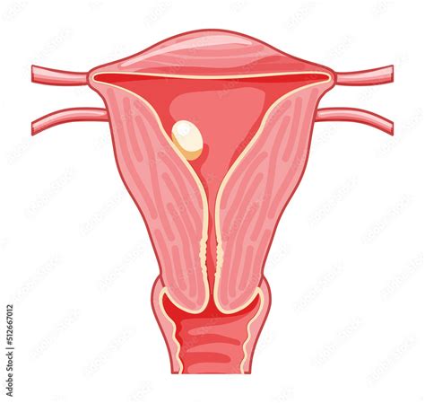 Sessile Polyp In The Uterus Female Reproductive System In Cross