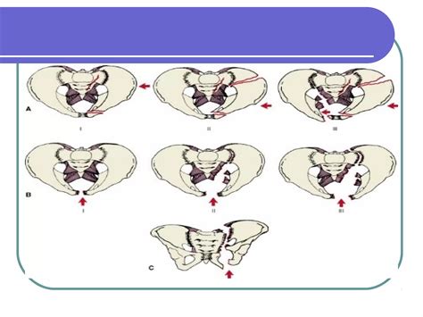 Pelvic Fractures Classification And Management Ppt
