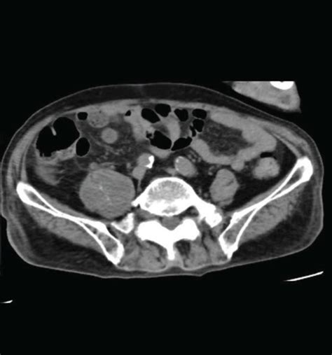 Truncal Computed Tomography Ct Findings On Arrival Truncal Ct Axial Download Scientific