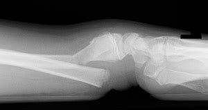 Distal Ulnar Metaphysis Wrist Fracture Egqztf