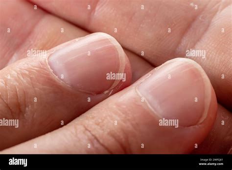 Trenches In Fingernails Vertical
