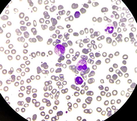 Setareh Sheikhi On Linkedin Leukemoid Reaction With Toxic Granulation And Shift To The Left Wbc…