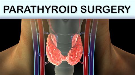Parathyroid Surgery Medical Animation Youtube