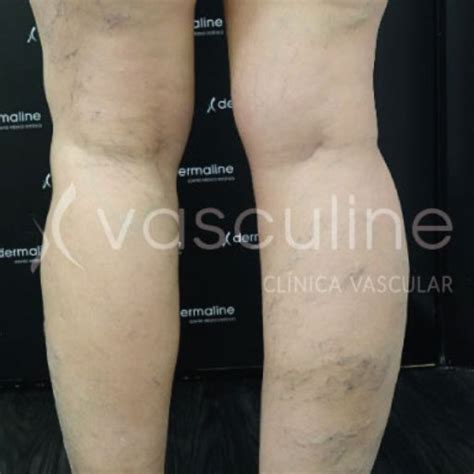 Flebitis En Las Extremidades Causas Síntomas Y Soluciones