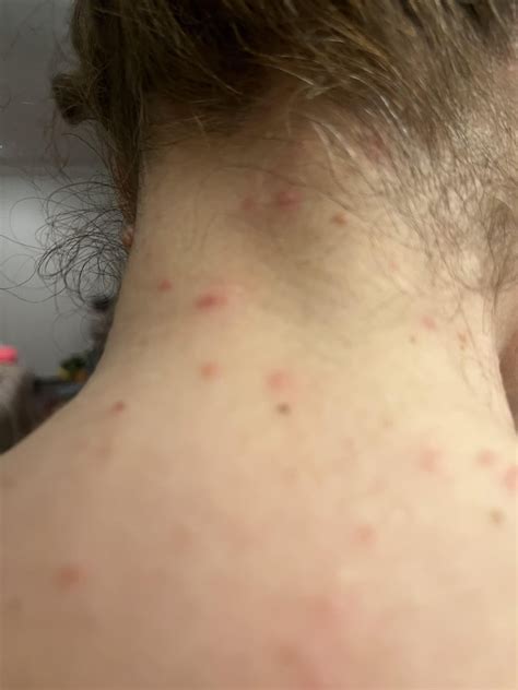 Please Help What Could These Red Bumps On The Back Of My Neck And