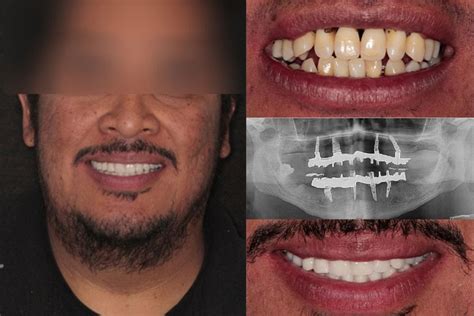 Cirugía Maxilofacial Maxilofacial Cdmx Dr Molina Moguel