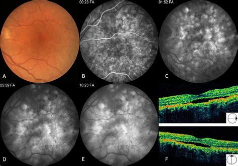 Figure 1 From Electroretinographic Findings In Transplant