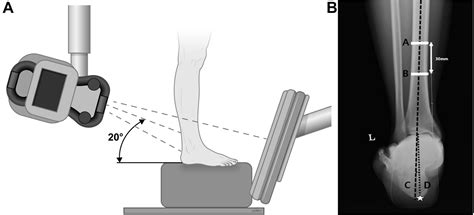 Intraoperative Assessment Of Hindfoot Alignment Using C Arm Fluoroscopy