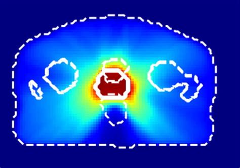 Dose Prediction With Deep Learning For Prostate Cancer Radiation Therapy Model Adaptation To