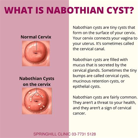 Nabothian Cysts Also Called Mucinous Springhill Clinic Facebook