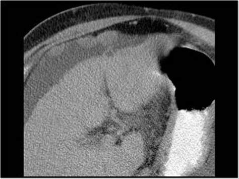 Abdomen And Retroperitoneum 11 Liver Case 1110 Perihepatic