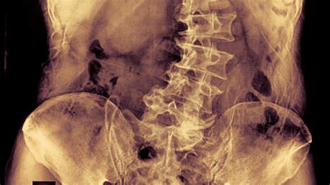 Scoliosis Radiologia Cobb Angle Kccr