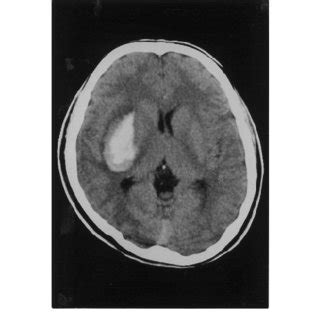 Cerebral Ct Scan Reveals Hemorrhage In The Right Putaminal Region