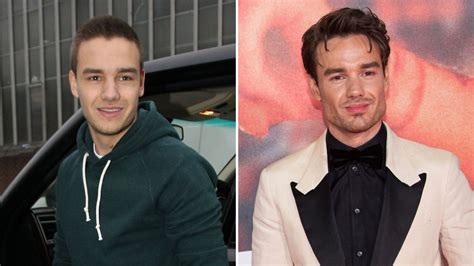 Liam Payne Jaw Surgery Whats The Talk