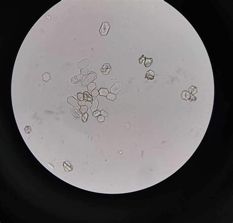 First Time Seeing Cystinuria Rmedlabprofessionals