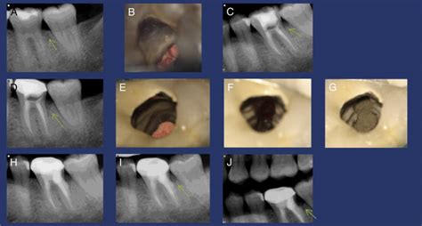 A Novel Treatment For Propagated Crown Fractures Journal Of Endodontics