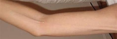 Axillary Web Syndrome Aws Cording” What Is It