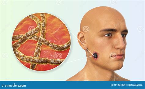 Cutaneous Anthrax The Most Common Form Of Anthrax Stock Illustration Illustration Of Sick