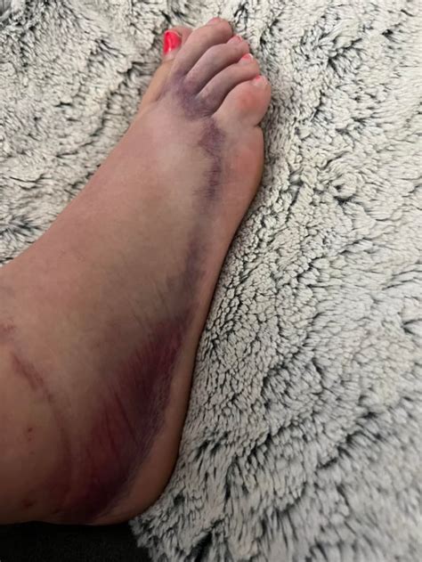 Ankle Sprain Bruising Normal Rfootfunction