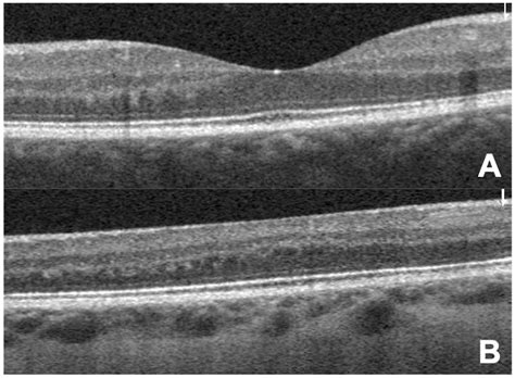 Spectral Oct Retina
