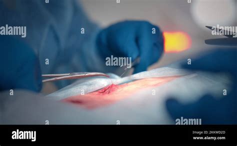 Retention Suture Stock Videos And Footage Hd And 4k Video Clips Alamy