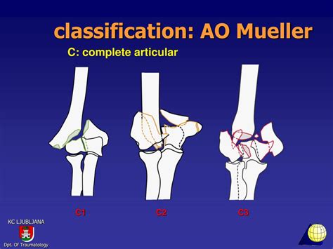 Ppt Distal Intraarticular Humerus Fractures Powerpoint Presentation
