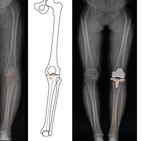 Radiograph Showing The Measurement Of Mpta Mpta Is The Medial Angle