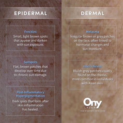 Ony Laser Singapore Not All Pigmentation Is The Same 🌿 Understanding