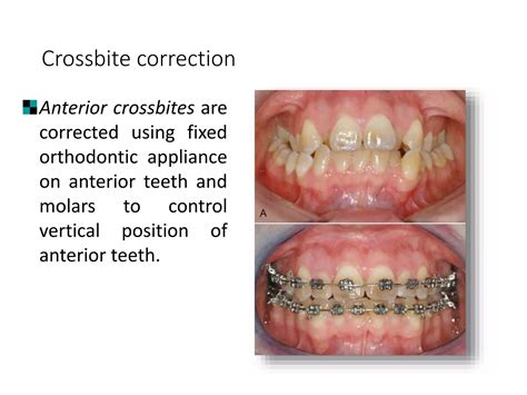 Adult Orthodontics Pptx