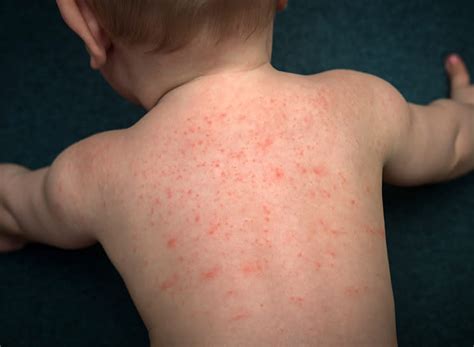 Allergy Rash Body At Christopher Trawick Blog